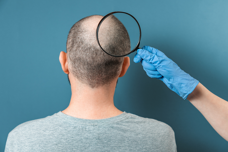 Haarausfall beim Mann: Ursachen & Therapien